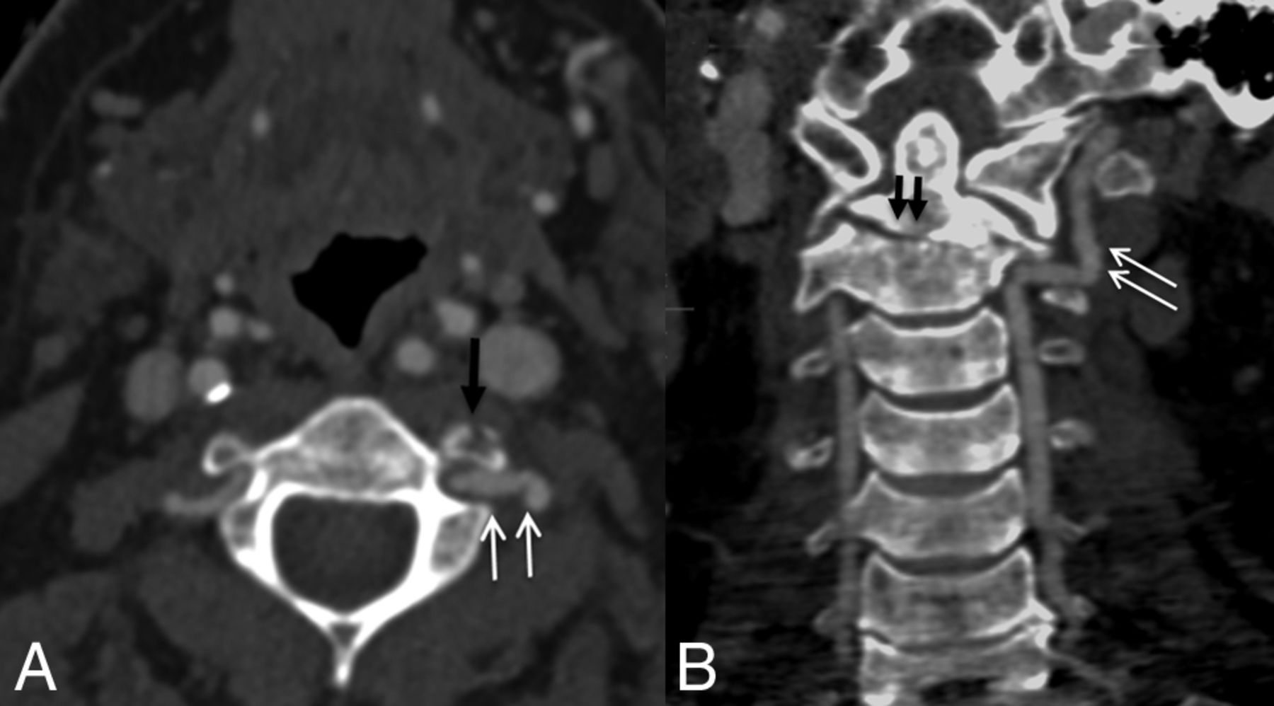 CT Angiography Screening for Blunt Cervical Vascular Injury - Evidence ...